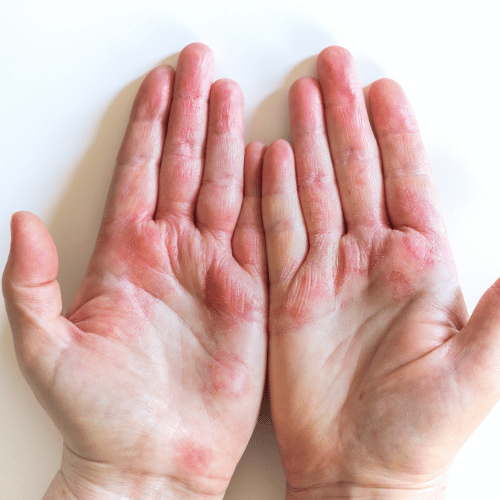 Sokat ront a stressz a tenyér-talpi ekcémán